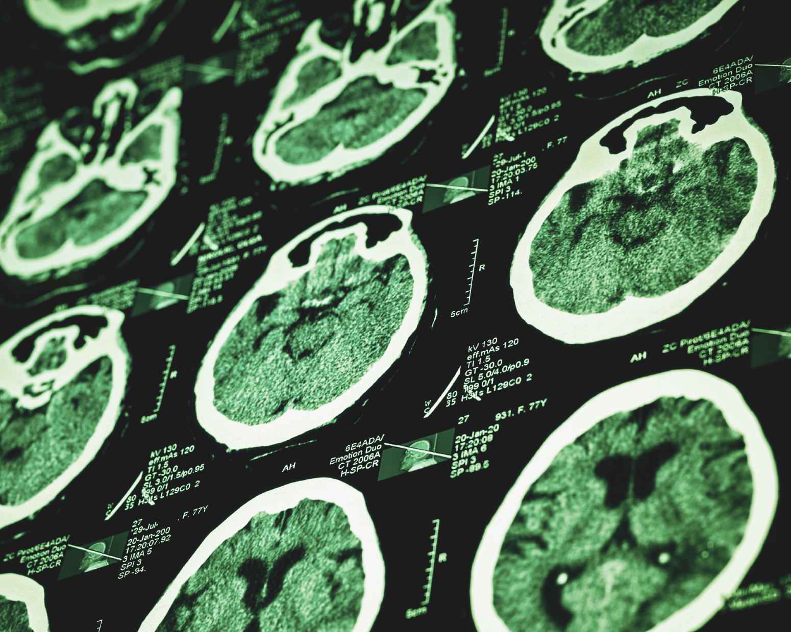 Imaging study confirms differences in ADHD brains - The University of ...