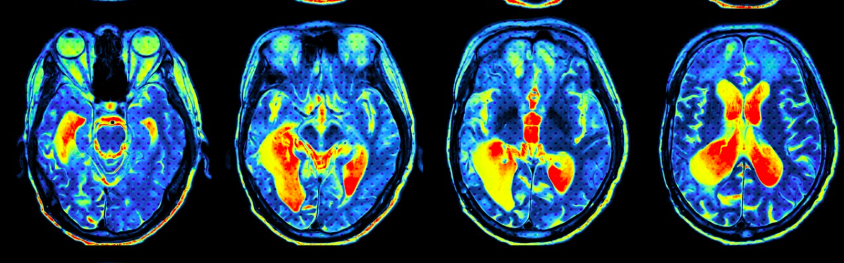 Disentangling the evolved brain from its primitive state - The ...
