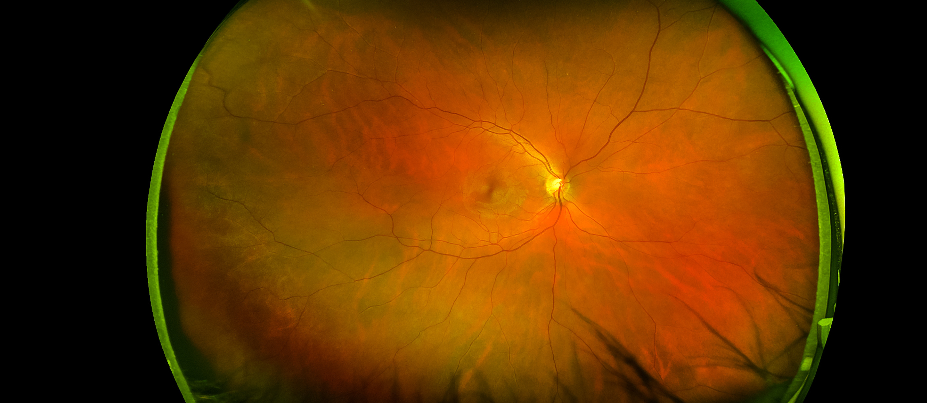 Macular Research Information Webinar - Save Sight Institute